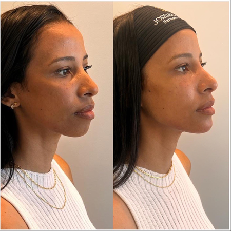 Preenchimento Malar, Mento e Mandíbula